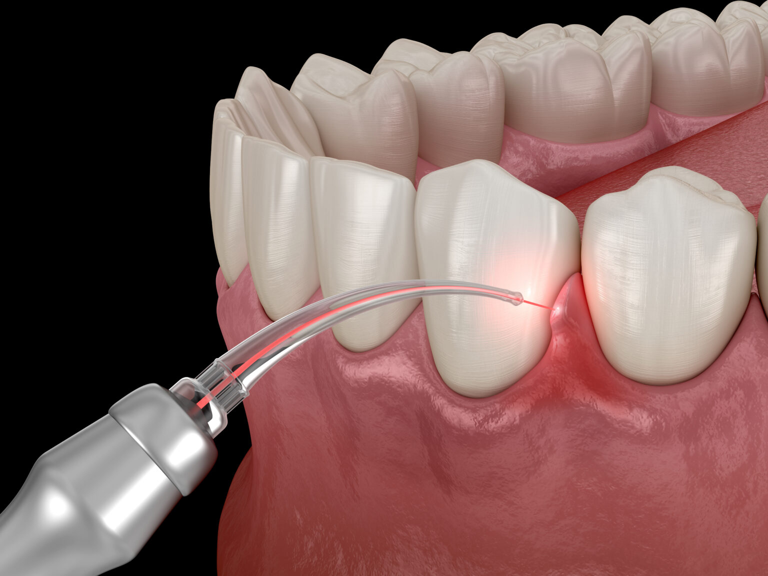 Contouring Your Gum Line In One Visit | Lake Orion, MI